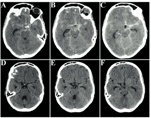RELATO DE CASO SOBRE EVOLUÇÃO ATÍPICA APÓS HEMORRAGIA SUBARACNÓIDEA