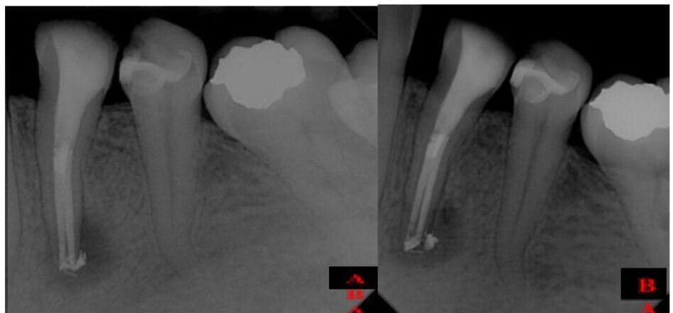 CONCEITO MICROSONICS NA REMOÇÃO DE INSTRUMENTO ENDODÔNTICO FRATURADO ...